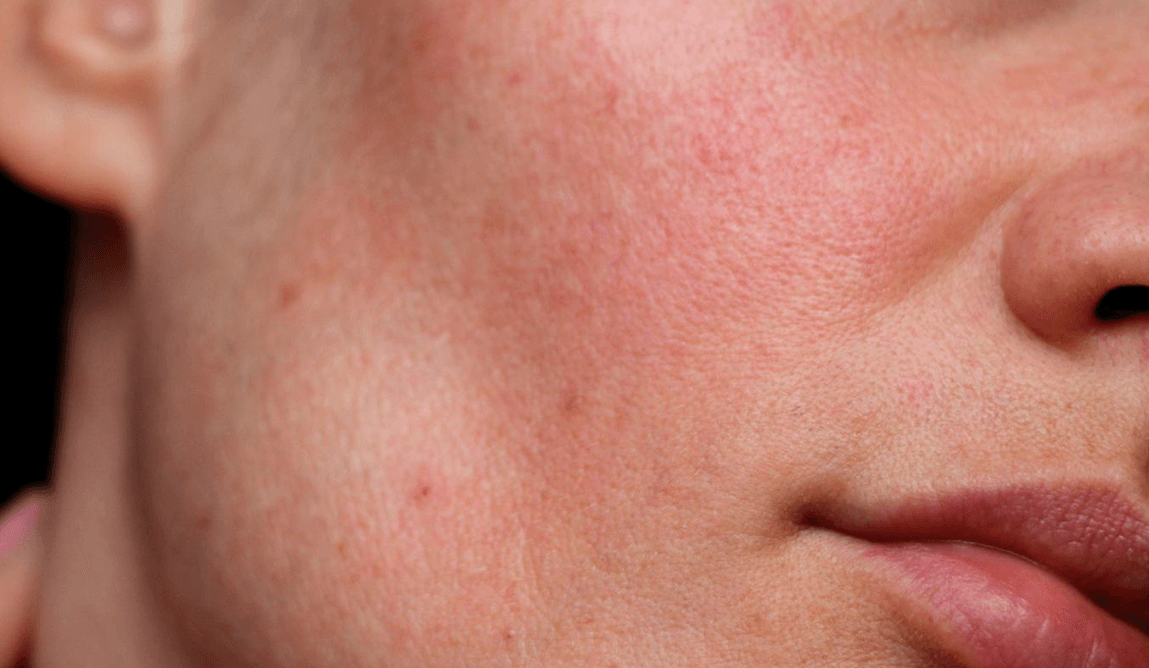 SAIBA O QUE SÃO VASINHOS NA FACE E COMO TRATÁ-LOS - Clínica Medspa